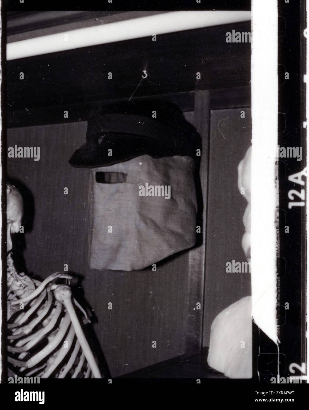 Joseph 'John' Carey Merrick (1862-90) - aka The Elephant Man. Pathology ...