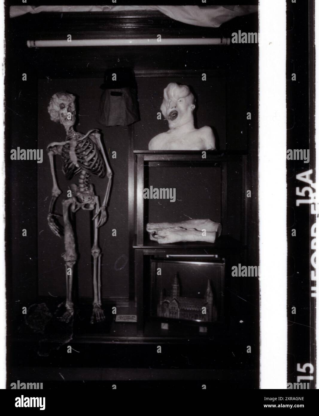 Joseph 'John' Carey Merrick (1862-90) - aka The Elephant Man. Pathology ...