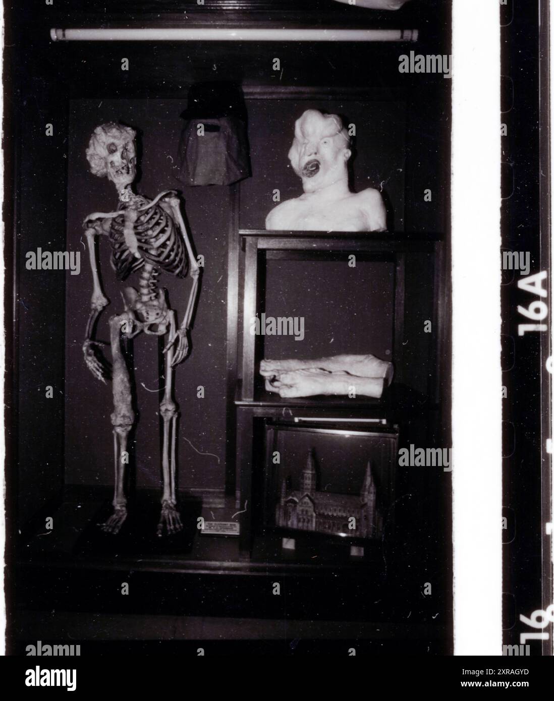 Joseph 'John' Carey Merrick (1862-90) - aka The Elephant Man. Pathology ...