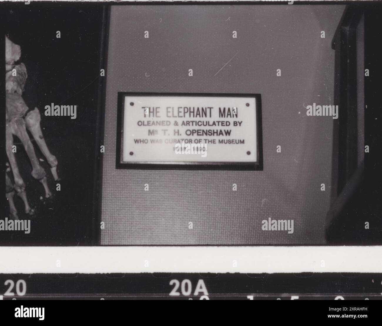 Joseph 'John' Carey Merrick (1862-90) - aka The Elephant Man. Pathology ...