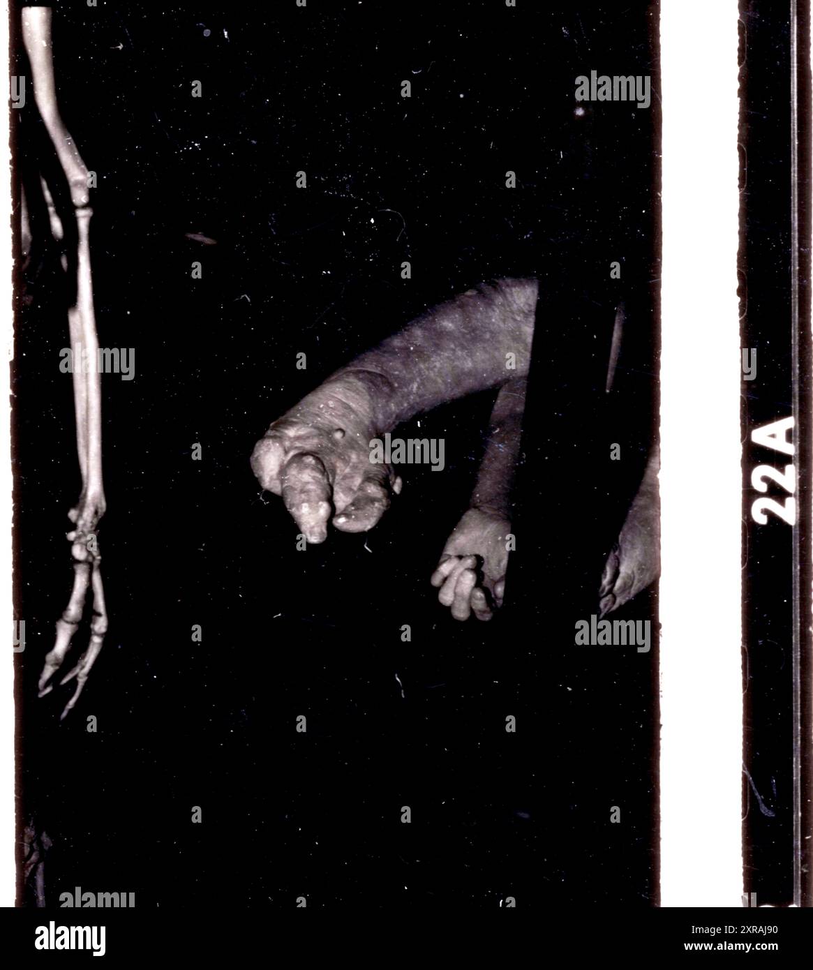 Joseph 'John' Carey Merrick (1862-90) - aka The Elephant Man. Pathology ...