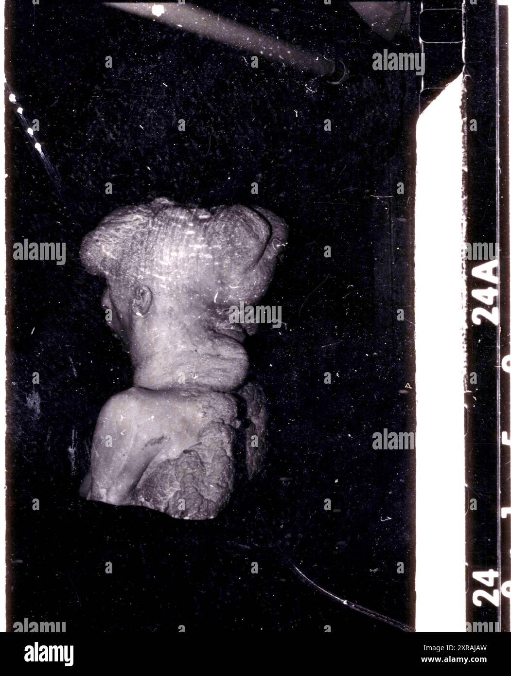 Joseph 'John' Carey Merrick (1862-90) - aka The Elephant Man. Pathology ...