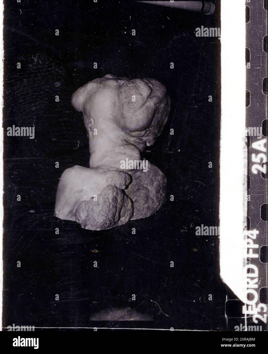 Joseph 'John' Carey Merrick (1862-90) - aka The Elephant Man. Pathology ...