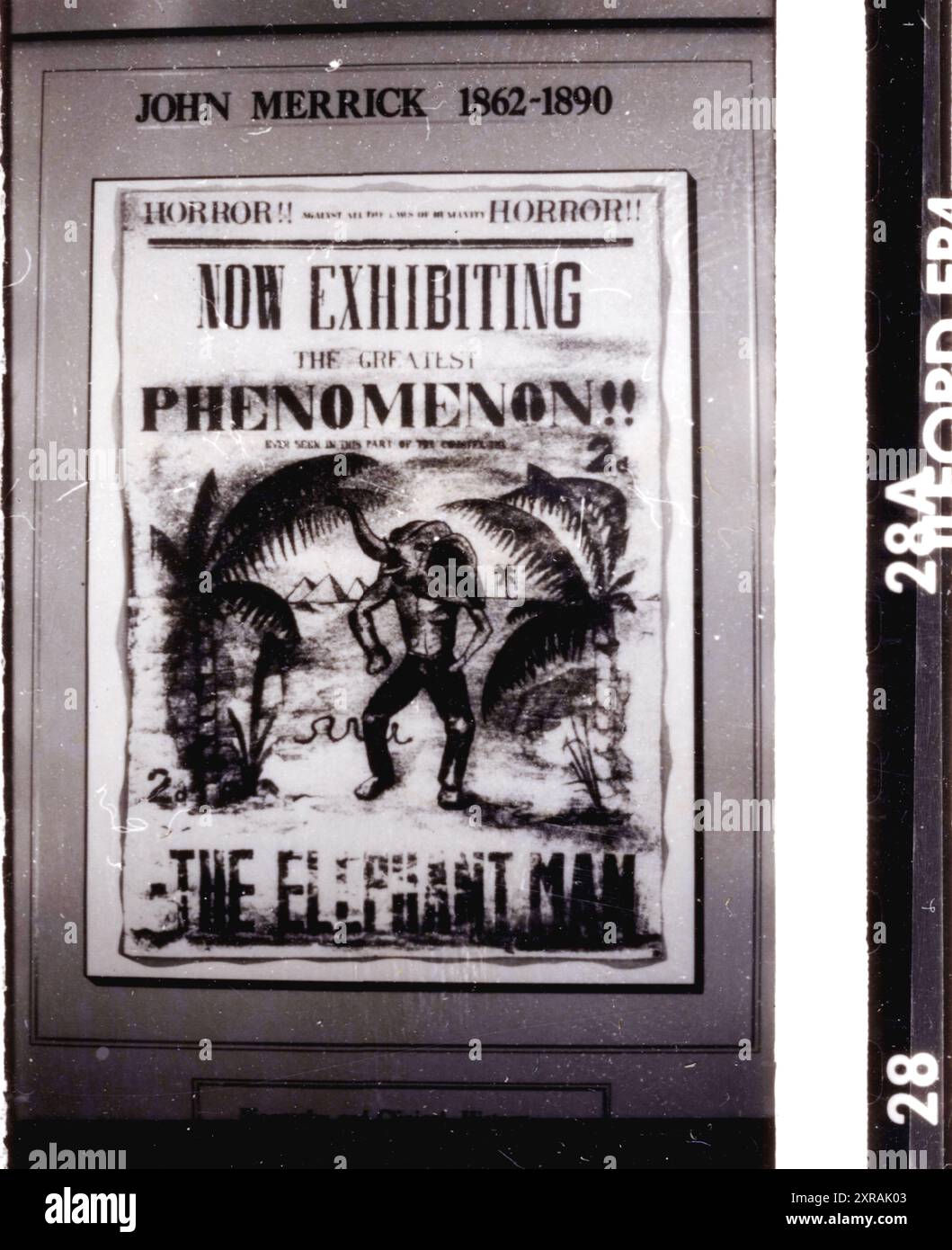 Joseph 'John' Carey Merrick (1862-90) - aka The Elephant Man. Pathology ...