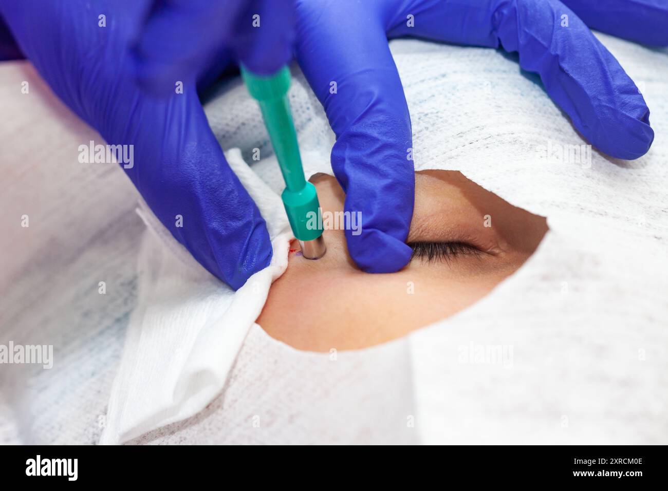 Skin lesion removal procedure. Dermatologist carrying out a removal of ...