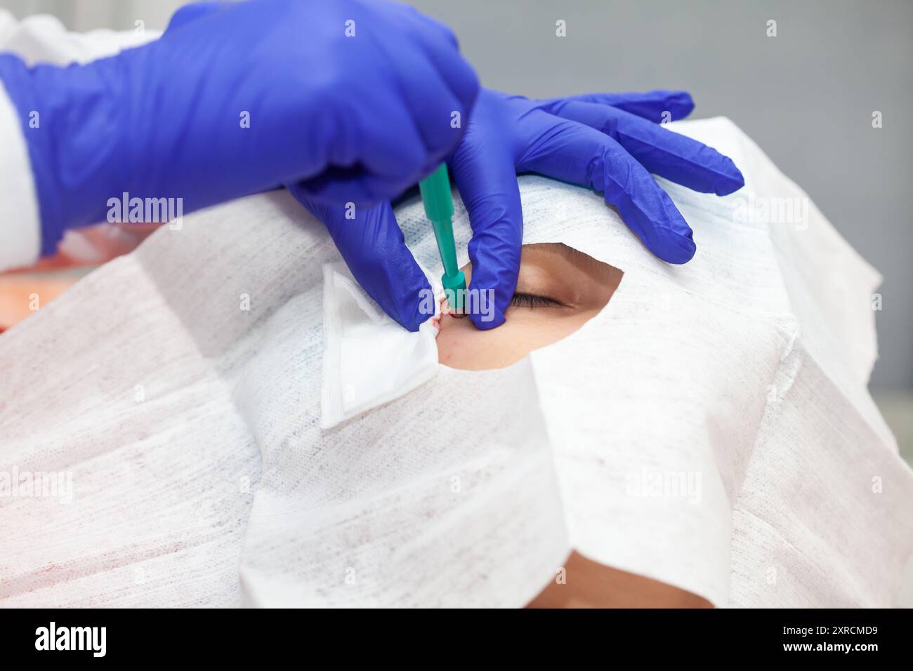 Skin lesion removal procedure. Dermatologist carrying out a removal of ...