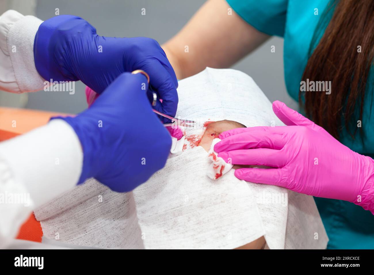Doctor suturing a patient during a small surgery. Dermatologist ...