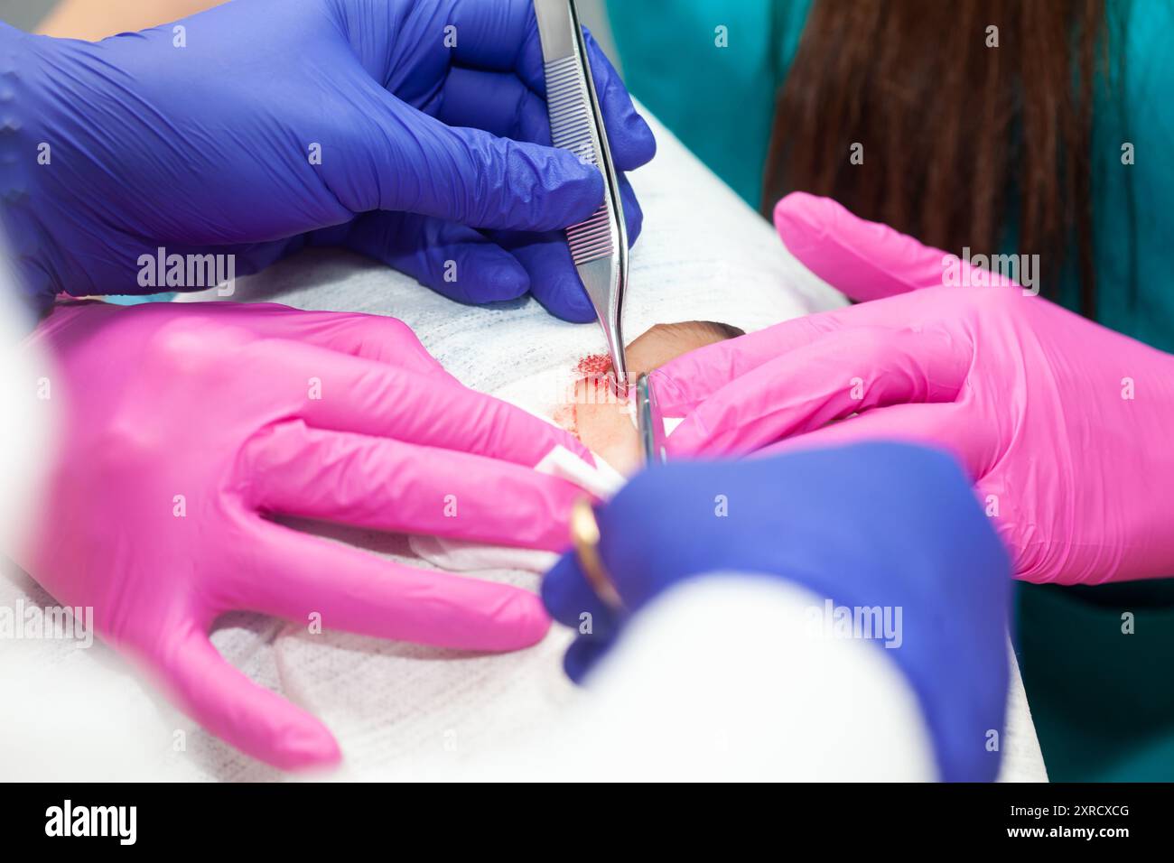 Doctor suturing a patient during a small surgery. Dermatologist ...