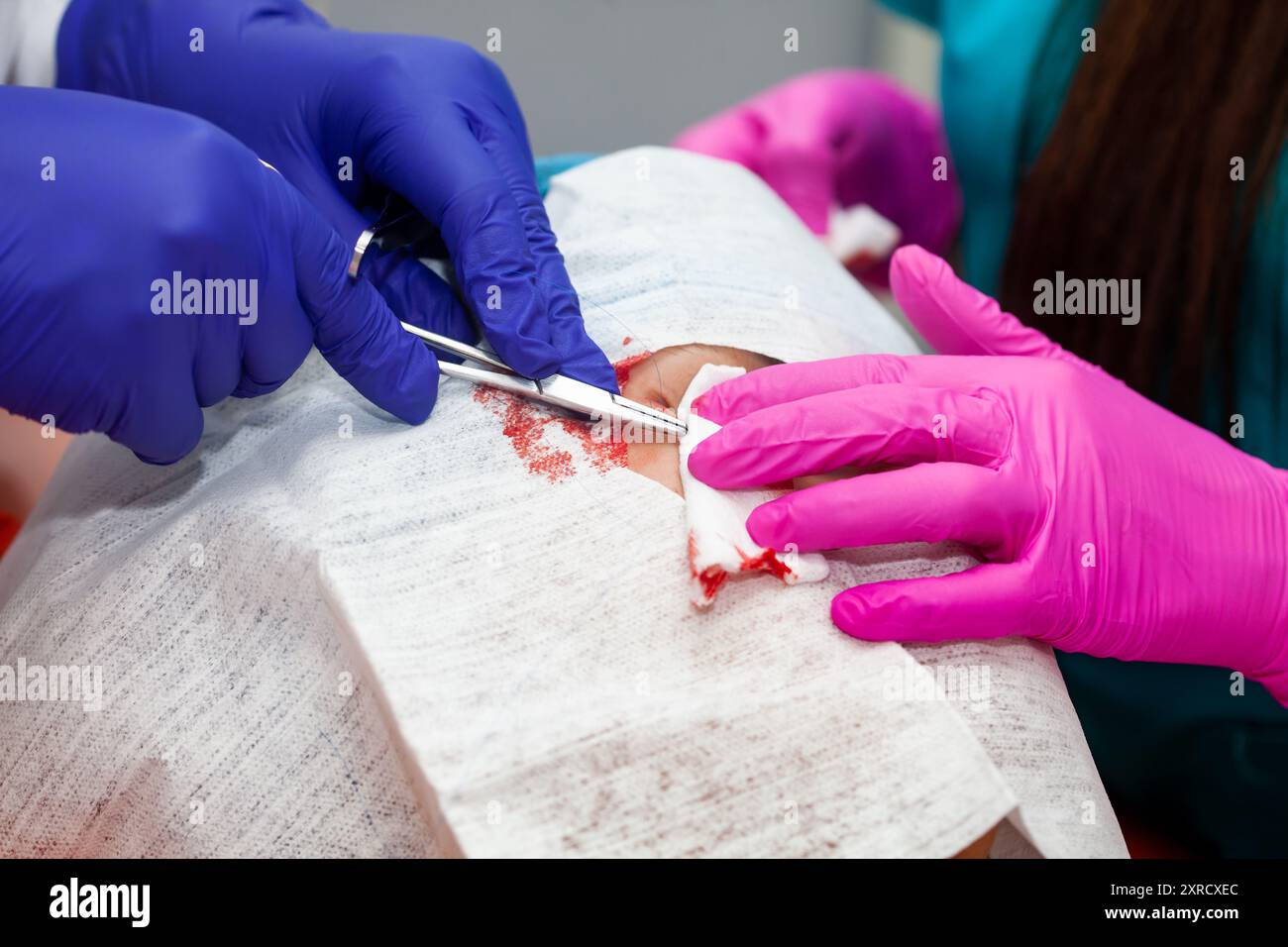 Doctor suturing a patient during a small surgery. Dermatologist ...