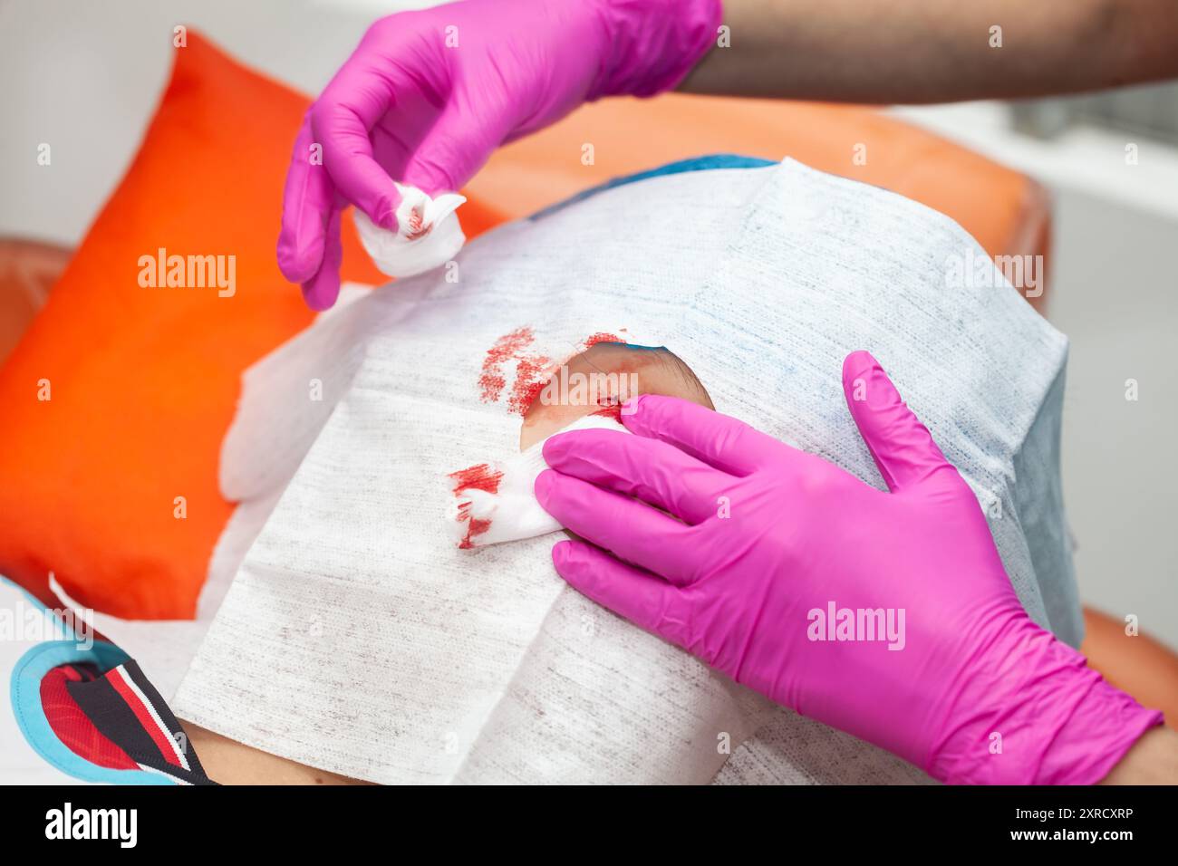 Doctor suturing a patient during a small surgery. Dermatologist ...