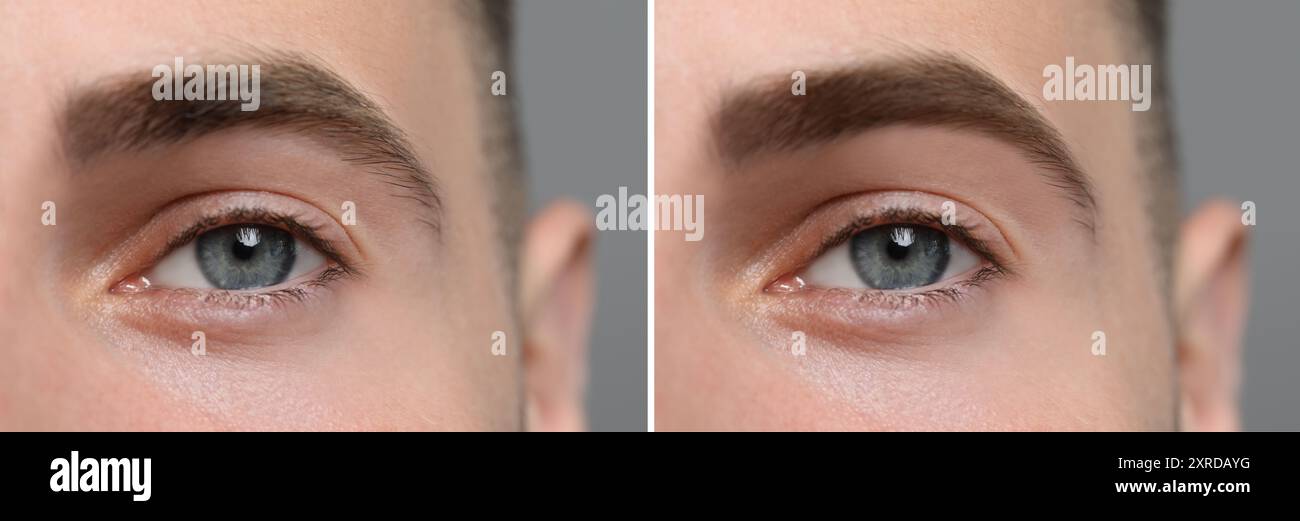 Man before and after permanent eyebrow procedure, collage with closeup ...