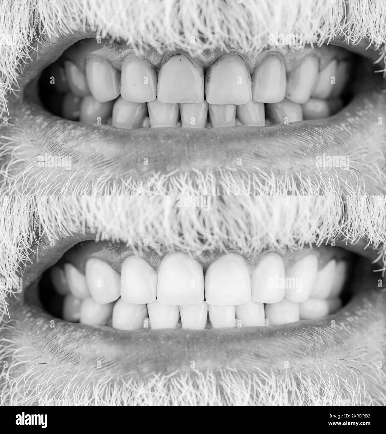 Male teeth before and after whitening, oral care dentistry, stomatology ...
