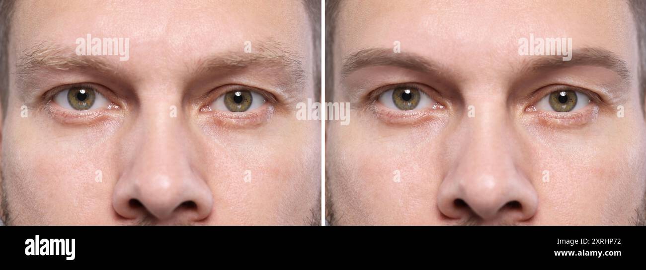 Man before and after permanent eyebrow procedure, collage with closeup ...