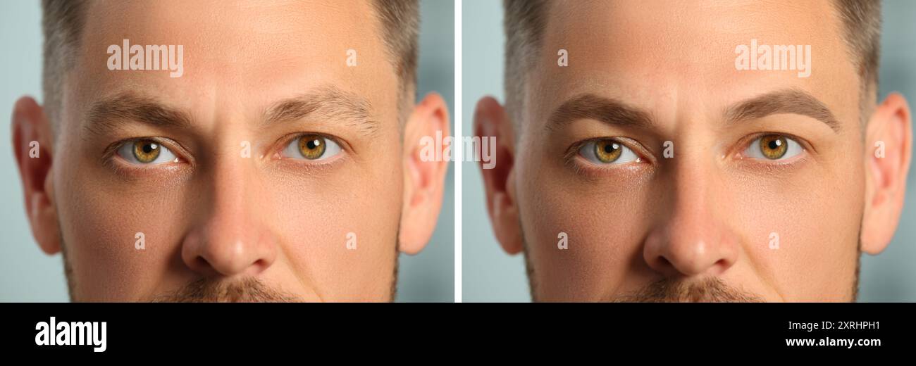 Man before and after permanent eyebrow procedure, collage with closeup ...