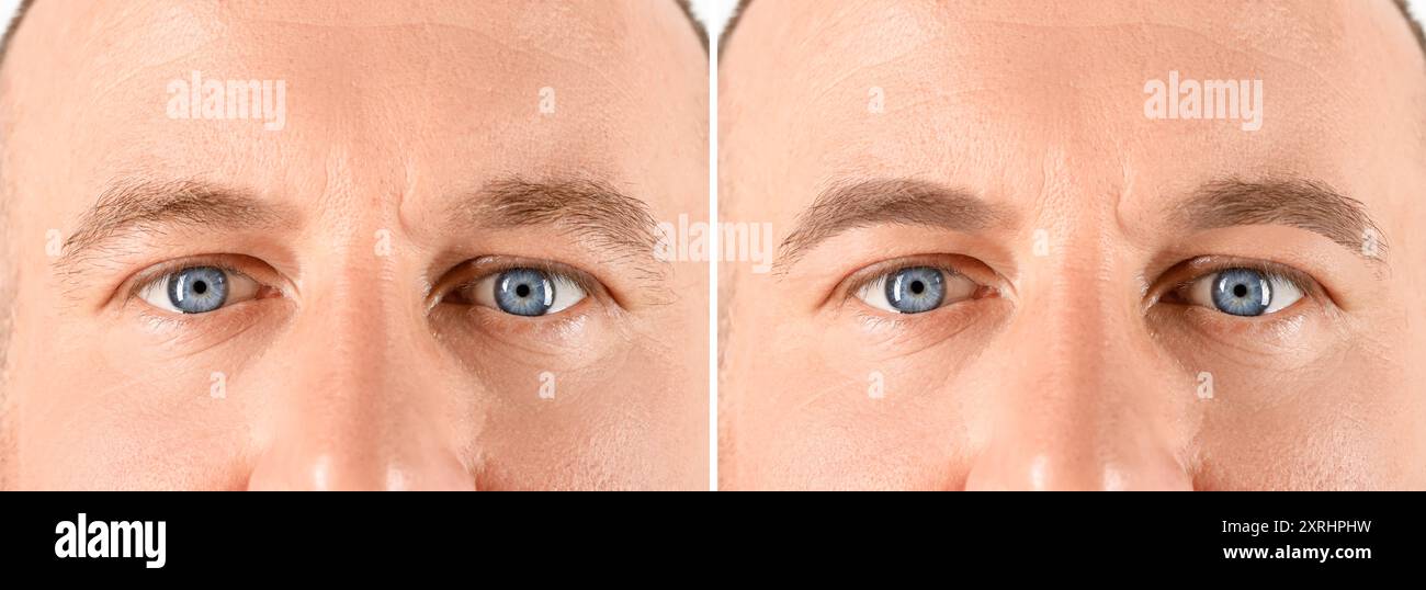 Man before and after permanent eyebrow procedure, collage with closeup ...