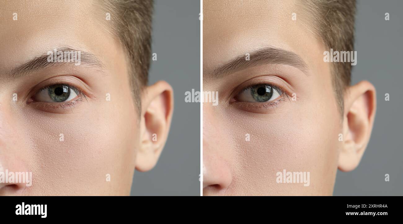 Man before and after permanent eyebrow procedure, collage with closeup ...