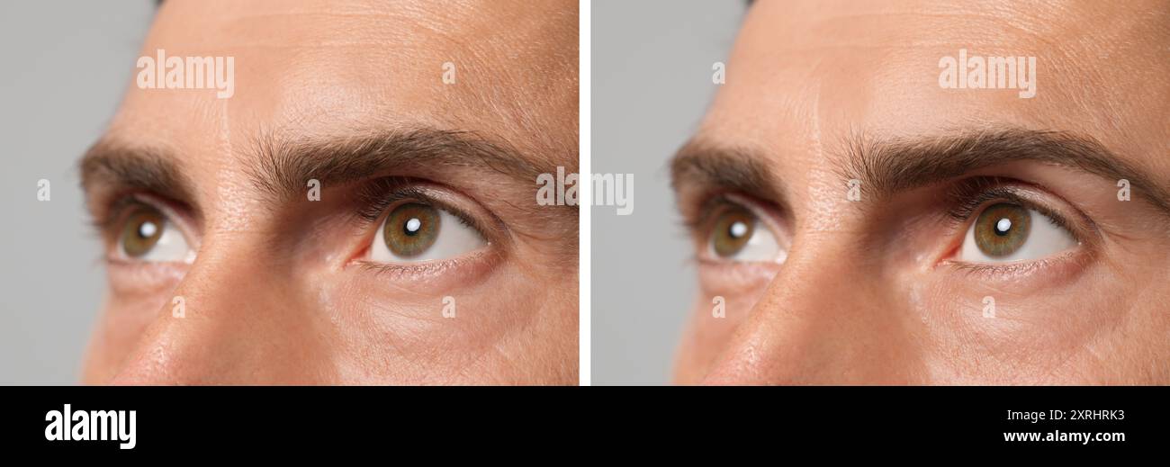 Man before and after permanent eyebrow procedure, collage with closeup ...