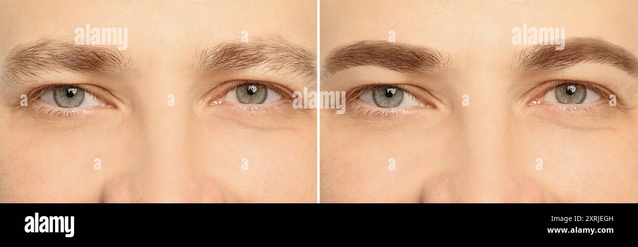 Man before and after permanent eyebrow procedure, collage with closeup ...