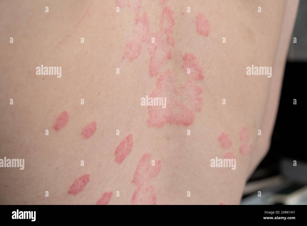Psoriasis red itchy scaly patches hi-res stock photography and images ...