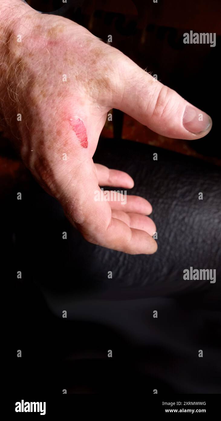 Man's hand with callus wound. Close-up. Dark background Stock Photo - Alamy