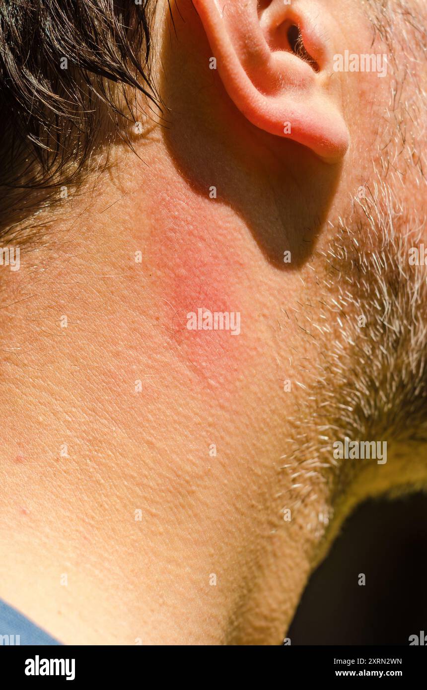 mosquito bites ticks on male neck closeup. High quality photo Stock ...