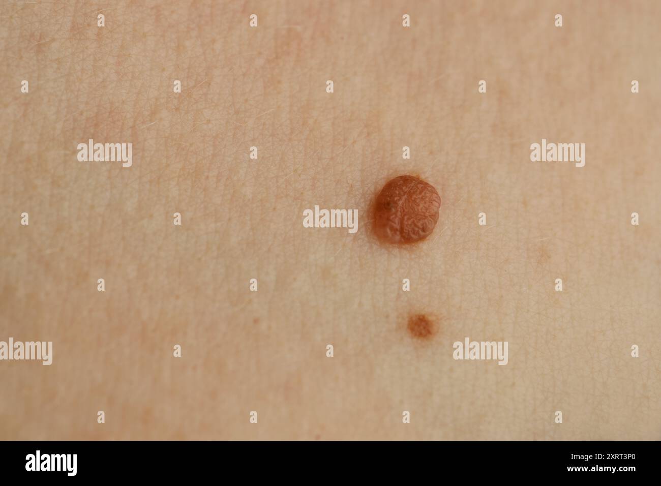 Woman with moles on her skin, closeup Stock Photo - Alamy