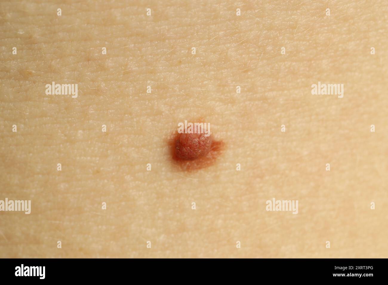 Woman with mole on her skin, closeup Stock Photo - Alamy
