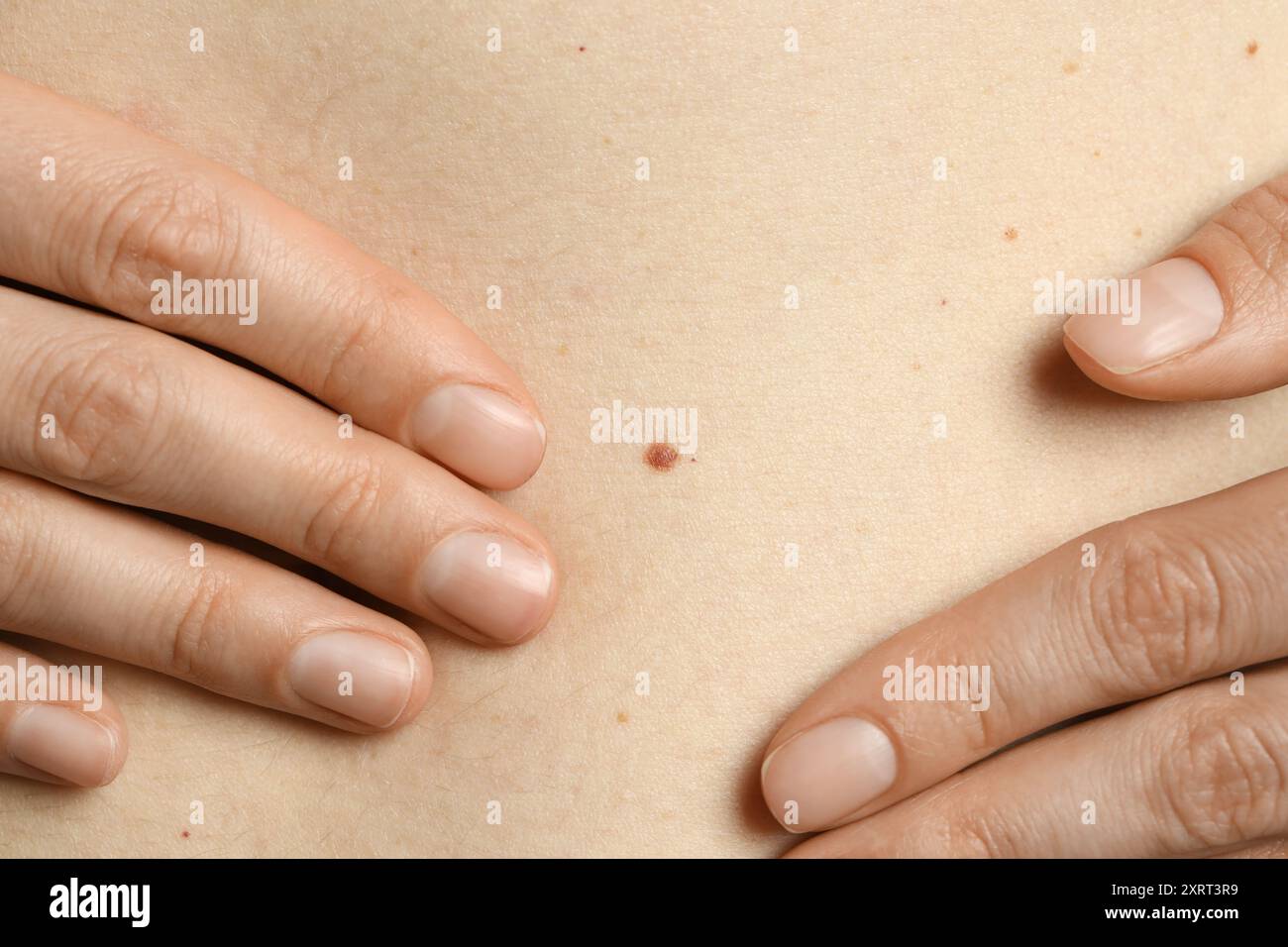 Mole skin problem disease hi-res stock photography and images - Alamy