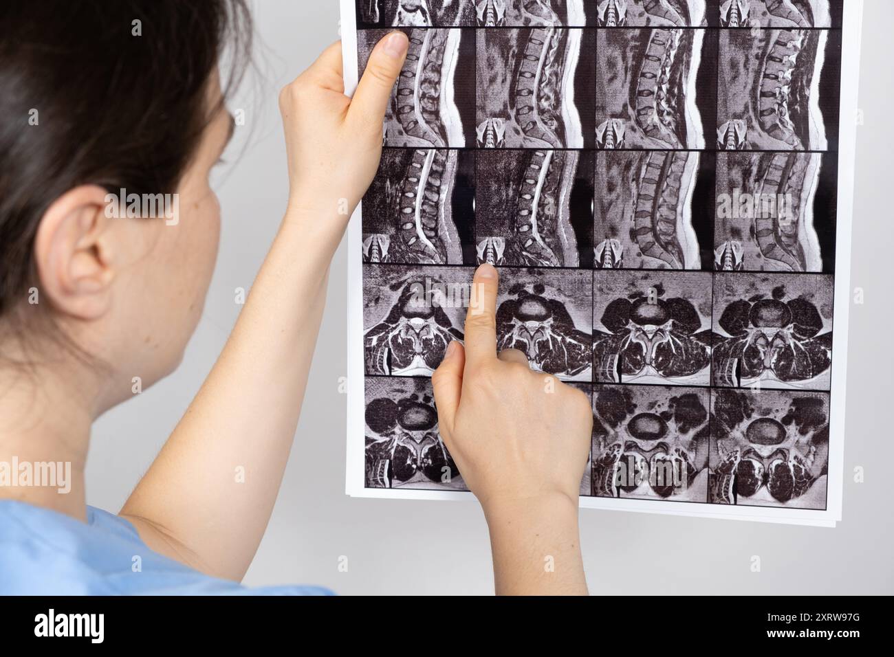 The doctor holds an MRI image of a patient with intervertebral disc ...