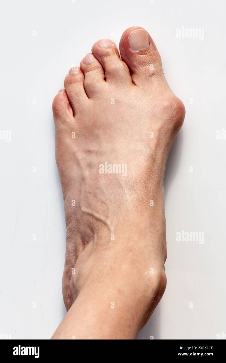 Hallux valgus hi-res stock photography and images - Alamy