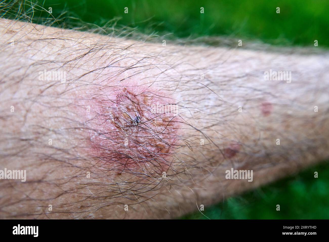 Bavaria, Germany - August 12, 2024: A second-degree burn on the arm ...