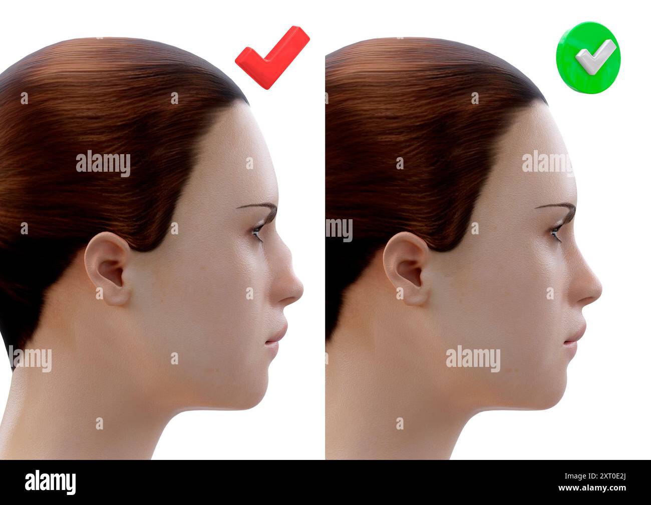 woman's nose before and after rhinoplasty isolated on white background ...