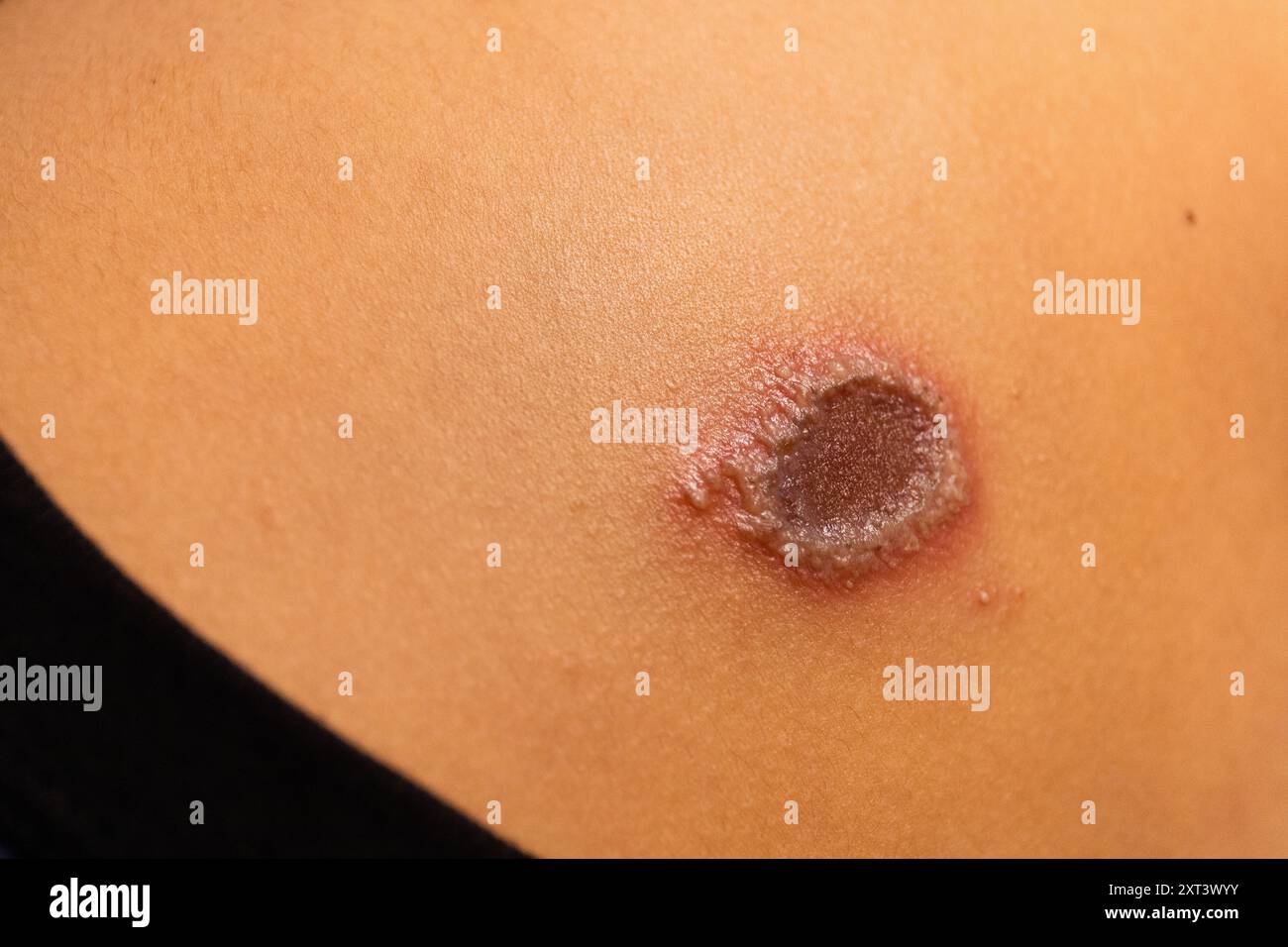 Infected insect bites hi-res stock photography and images - Alamy