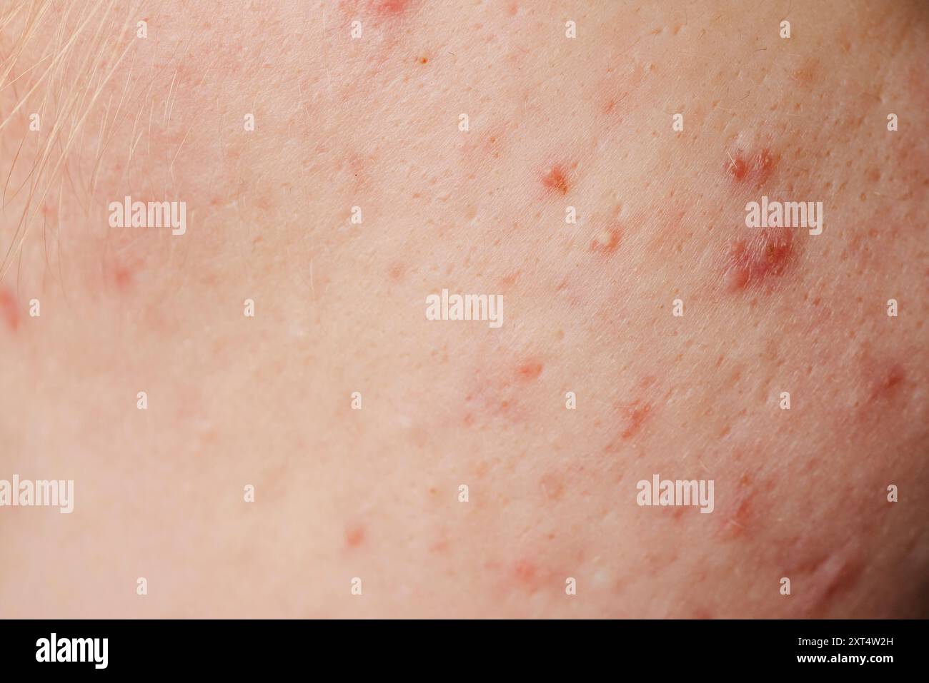 Skin acne background. Closeup acne pimple. Treatment for acne skin ...