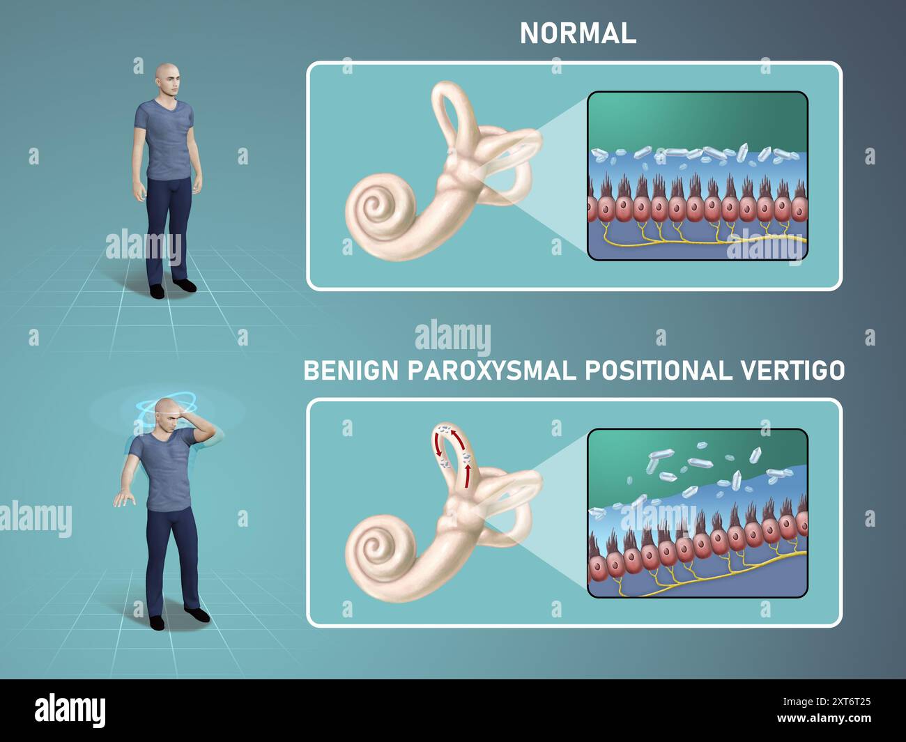 Benign paroxysmal positional vertigo. Vertigo caused by inner ear ...