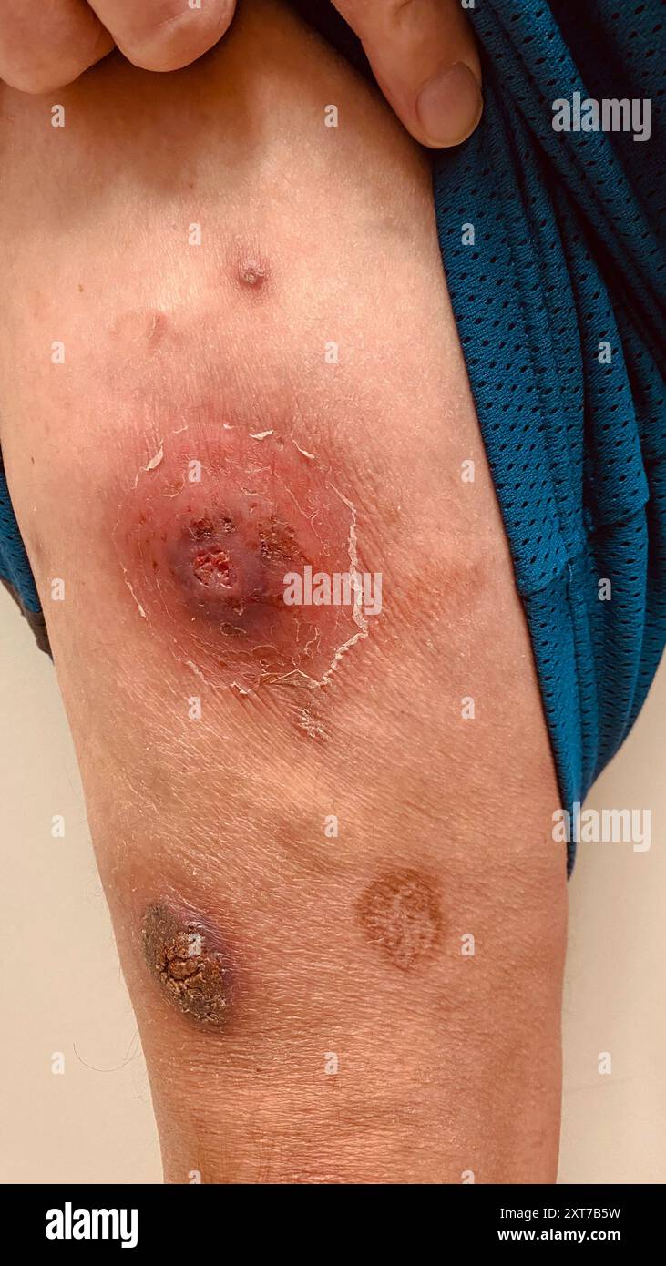 Pyoderma gangrenosum on a 40 year old white male patient's leg. This disease causes painful ...