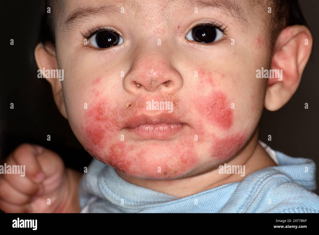 Cutaneous lesions on the face of a baby boy with acrodermatitis ...