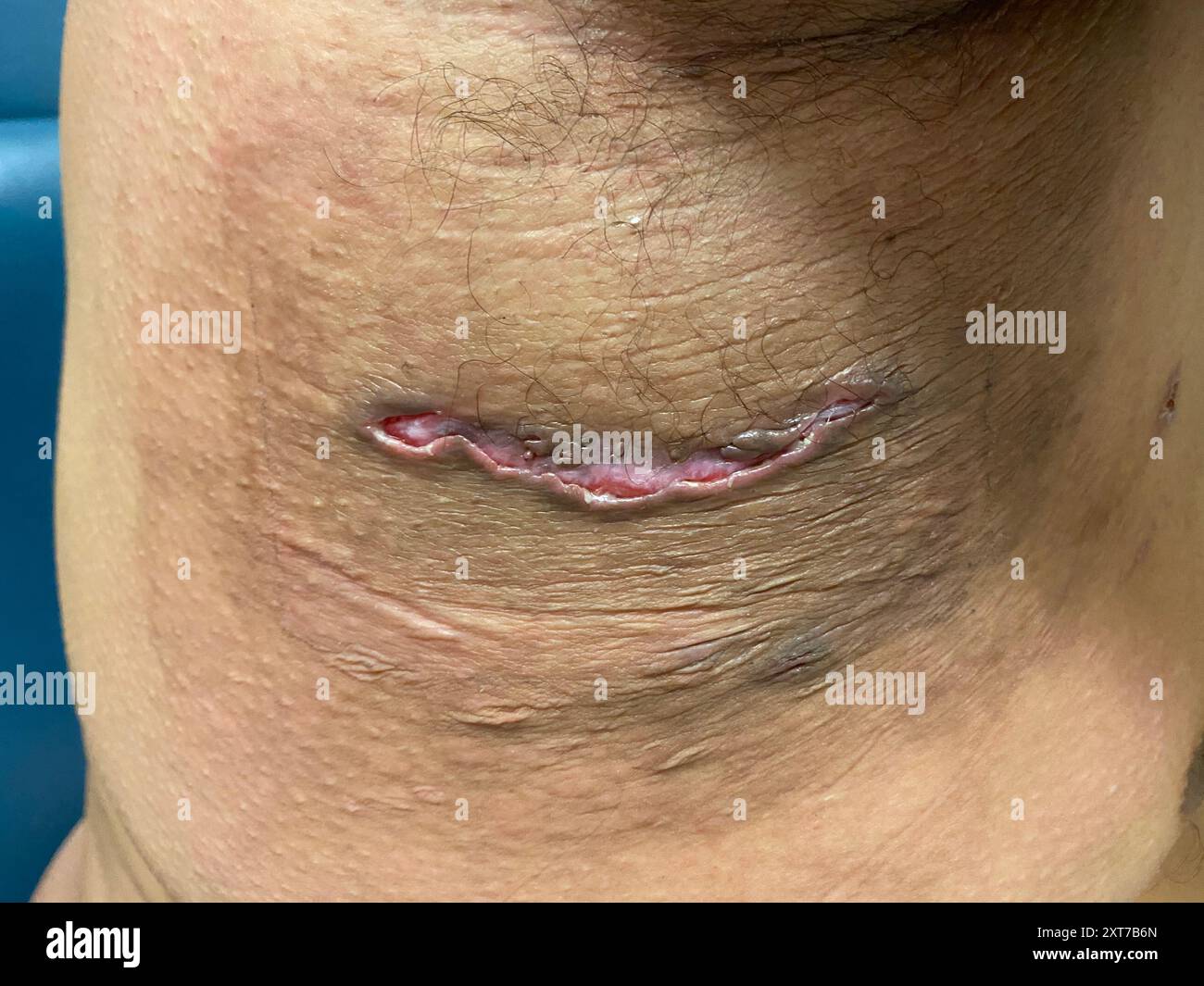 Pyoderma gangrenosum in a Hispanic male patient's armpit. This disease ...