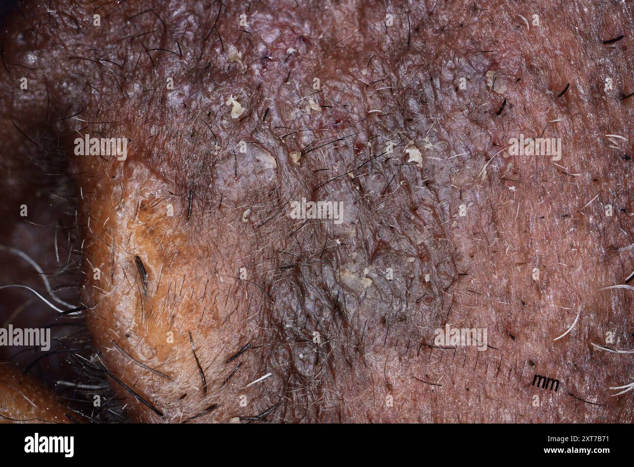 Dermatoscope image of papules on the skin of a patient with Darier's ...