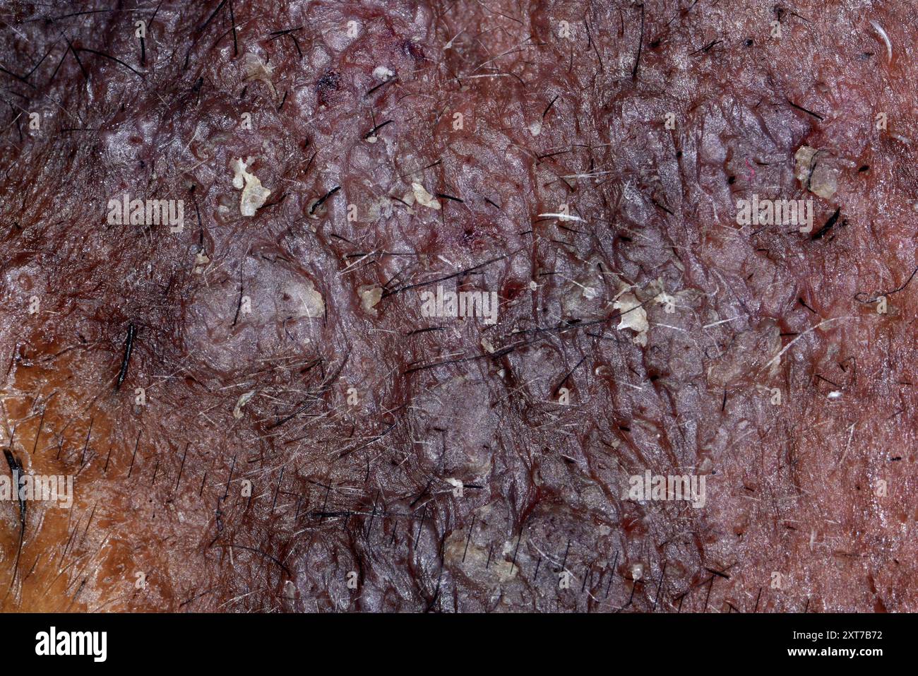 Dermatoscope image of papules on the skin of a patient with Darier's ...