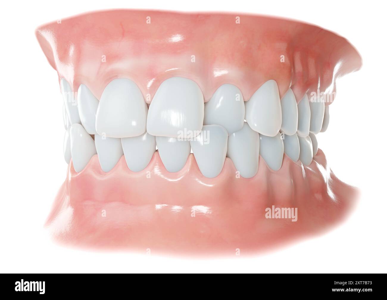 Illustration of a crossbite malocclusion, a teeth misalignment where ...