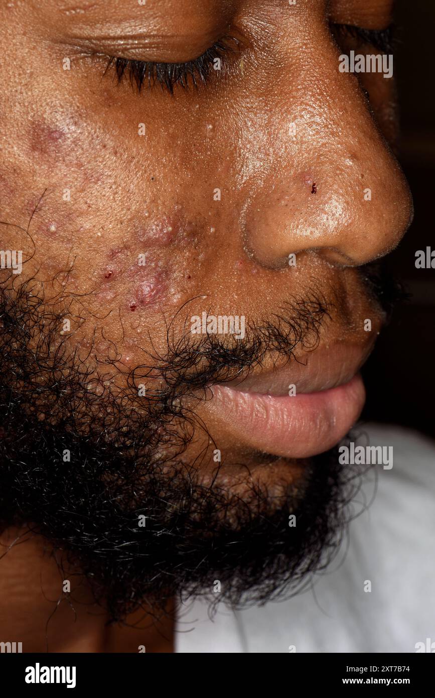 Dissecting cellulitis on a male patient's face. This condition is a chronic suppurative disease ...