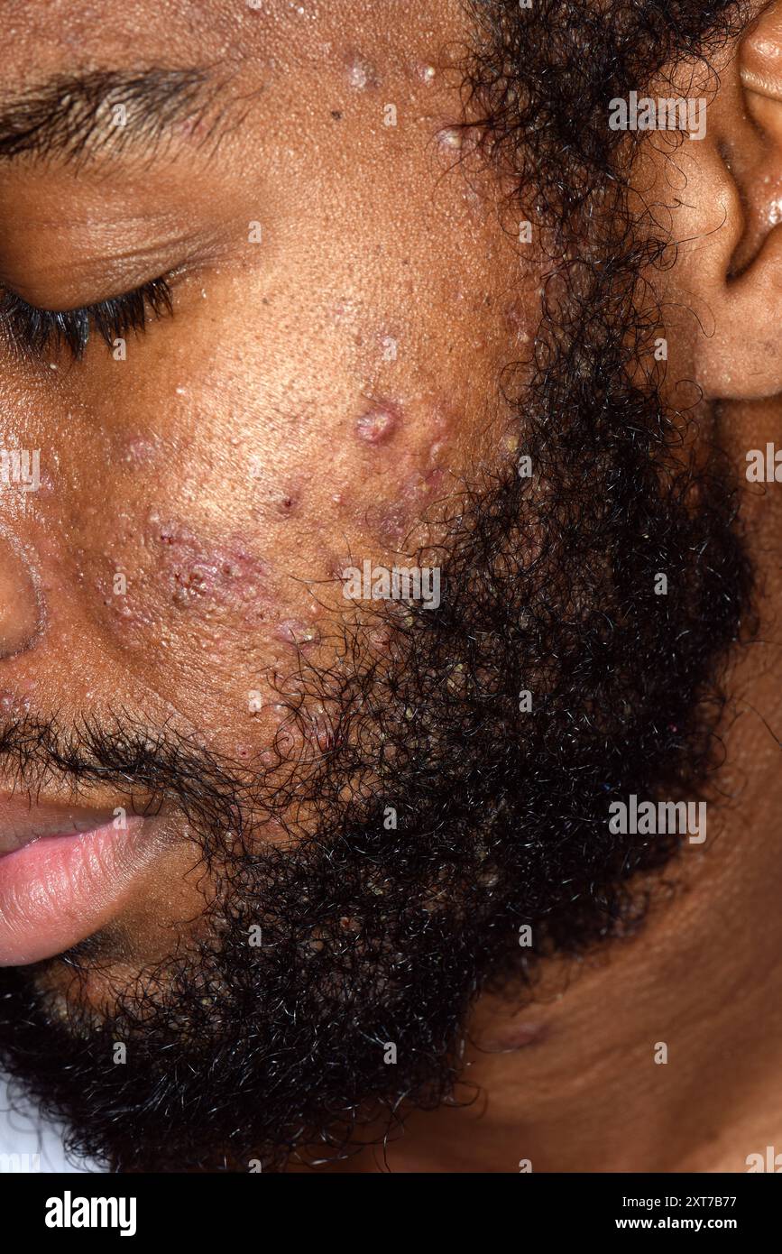 Dissecting cellulitis on a male patient's face. This condition is a chronic suppurative disease ...