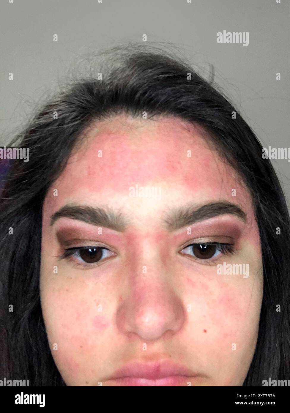 Rash on the face of a 24 year old female Hispanic patient with ...
