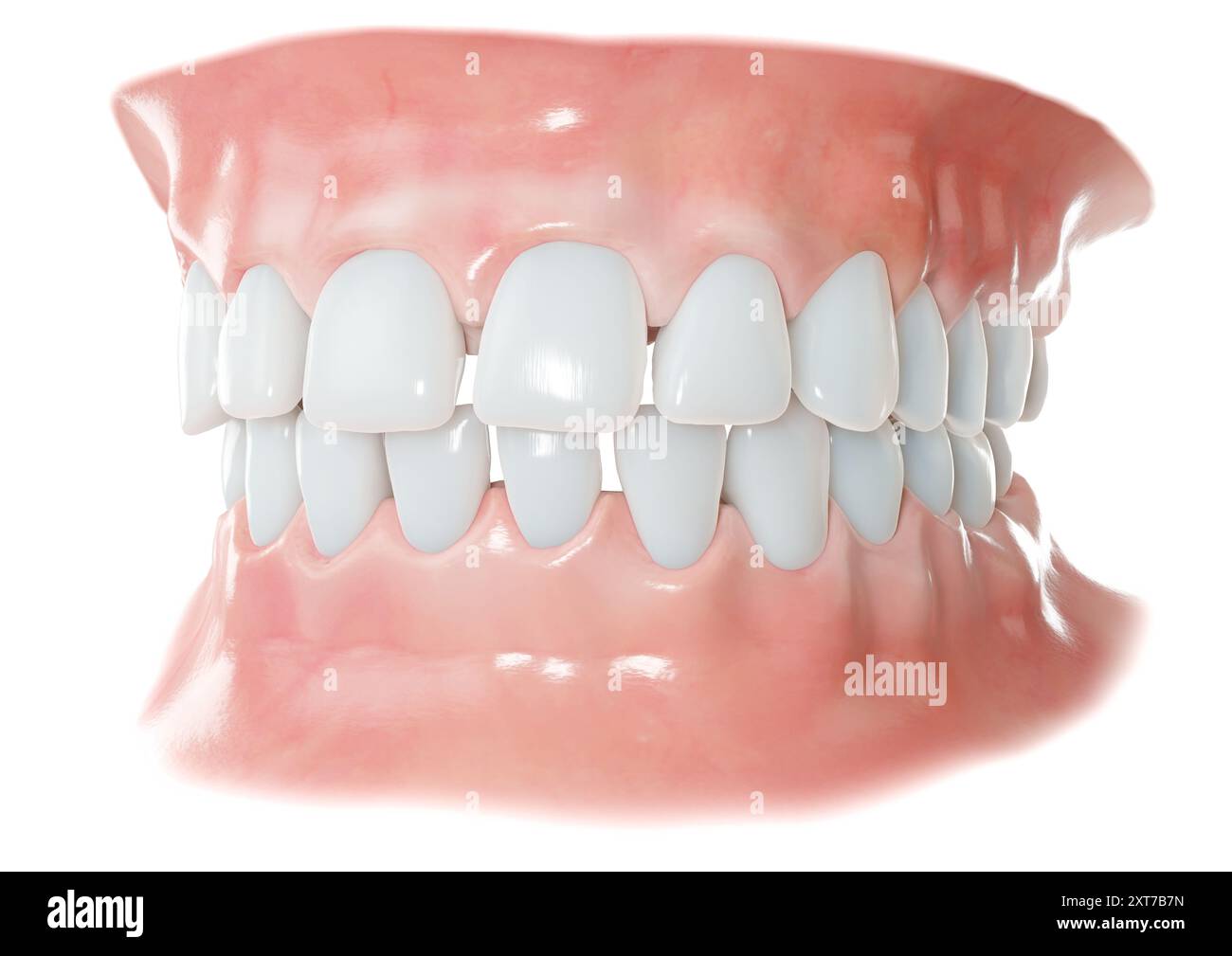 Illustration of gap teeth, a malocclusion where there are visible gaps ...