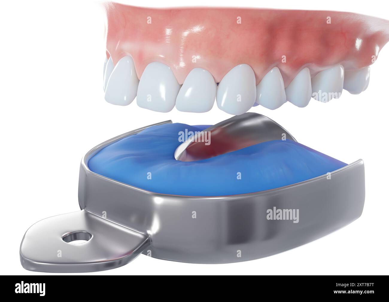 Illustration of a dental impression of the upper jaw. A negative ...