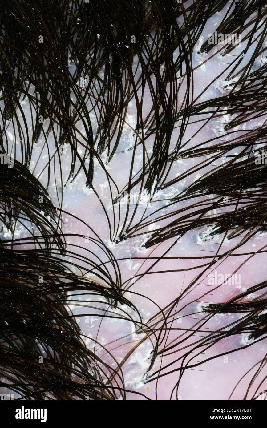 Dermatoscope image of the scalp of a 34 year old Hispanic female ...