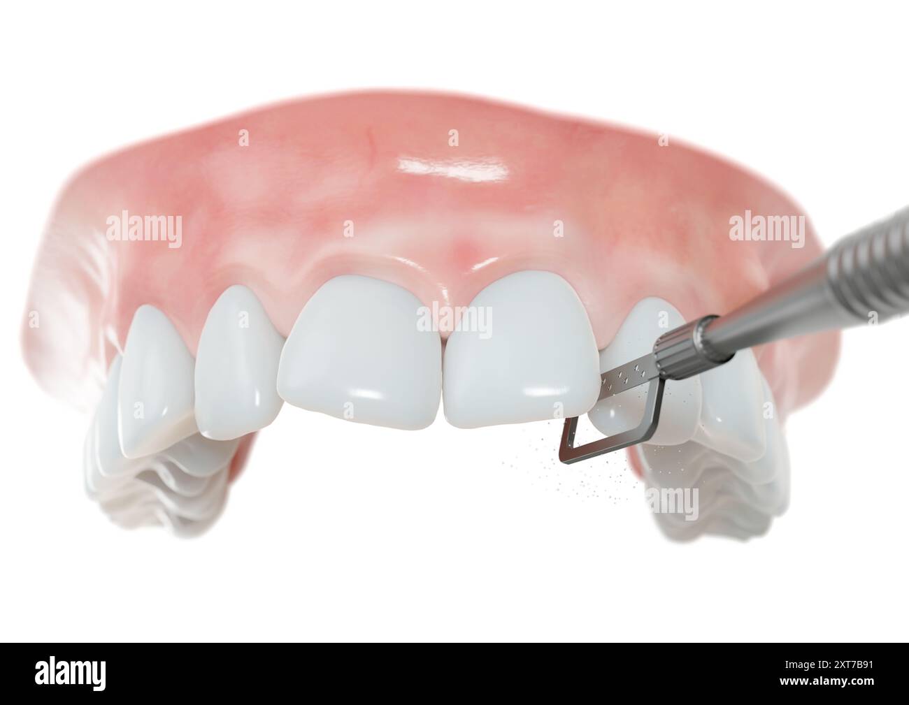 Illustration of an interproximal reduction of the tooth enamel. This ...