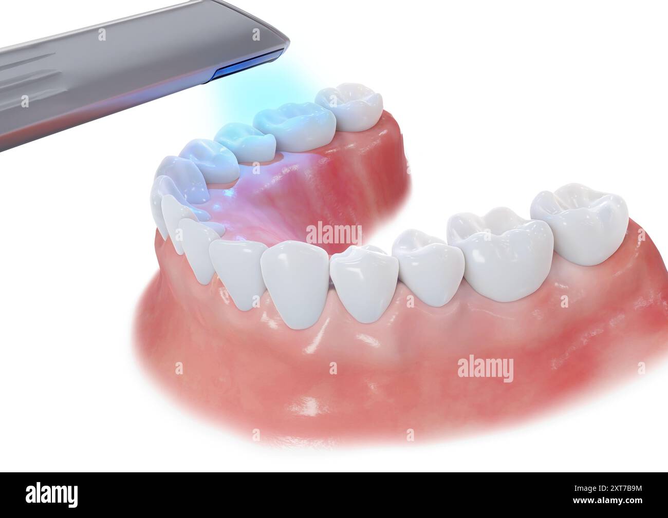 Illustration of an intraoral 3D scan of the lower jaw. A small camera ...