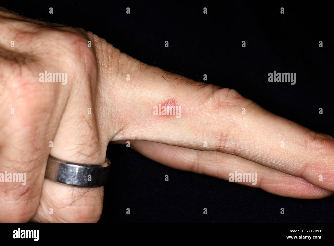Rash on the hand of a male patient infected with mpox (monkeypox). Mpox ...